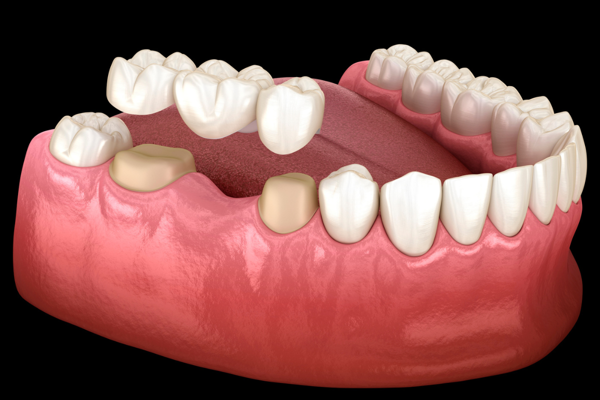 Are Same Day Crowns Safe? Dentists Reveal the Truth